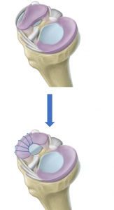 Ménisque discoïde - Nantes Chirurgie Jeunesse et Sport