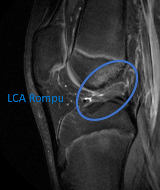 déchirure ligament croisé enfant en croissance (LCA)