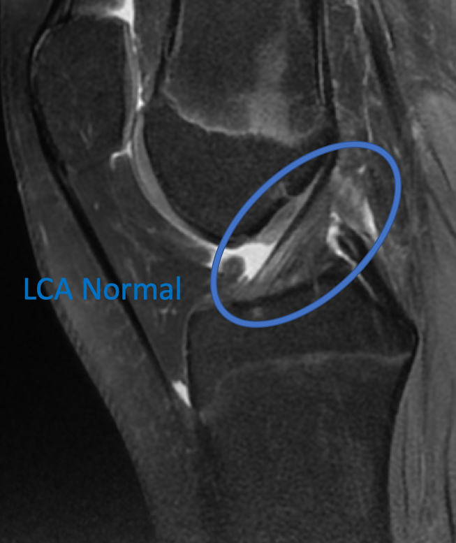 déchirure ligament croisé enfant en croissance (LCA)