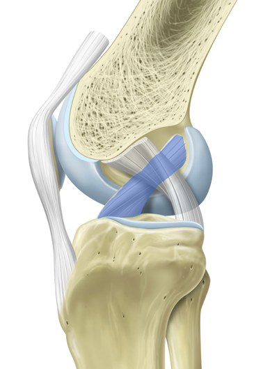 Rupture du Ligament Croisé Antérieur : causes, symptômes et traitements