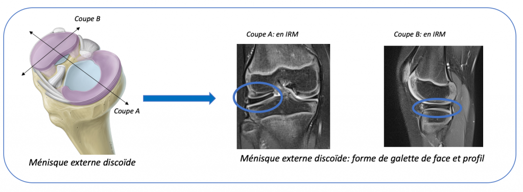 Ménisque discoïde - Nantes Chirurgie Jeunesse et Sport