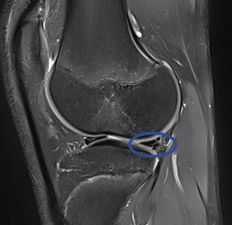 Lésion méniscale traumatique - Nantes Chirurgie Jeunesse et Sport