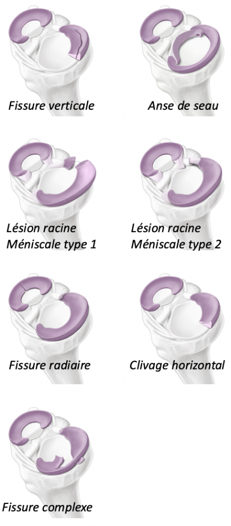Lésion méniscale traumatique - Nantes Chirurgie Jeunesse et Sport