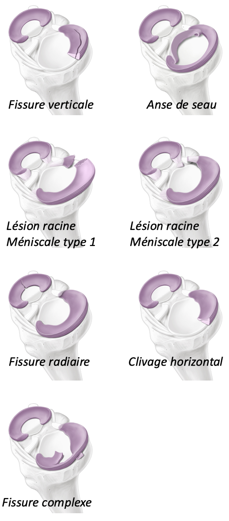 Lésion méniscale traumatique - Nantes Chirurgie Jeunesse et Sport