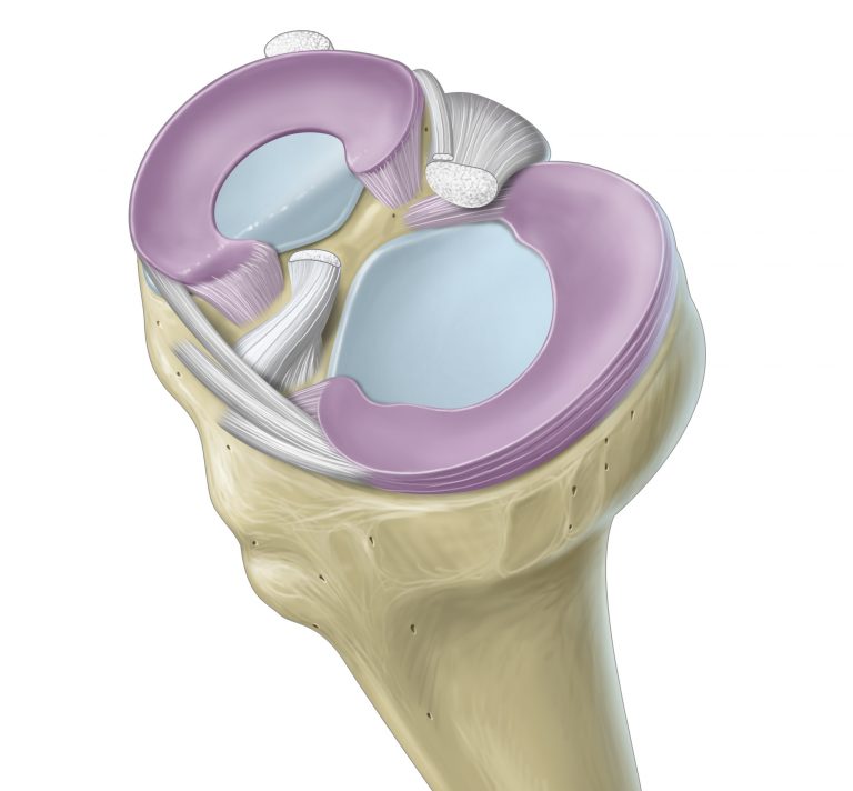 Lésion méniscale traumatique - Nantes Chirurgie Jeunesse et Sport