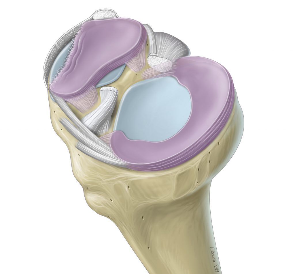 Ménisque discoïde - Nantes Chirurgie Jeunesse et Sport