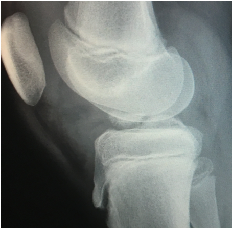 Fracture des épines tibiales : causes et traitement | NCJS