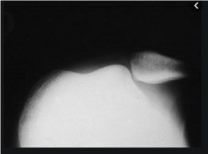 Instabilité et luxation de rotule - Nantes Chirurgie Jeunesse et Sport