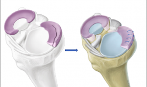 Lésion méniscale traumatique - Nantes Chirurgie Jeunesse et Sport