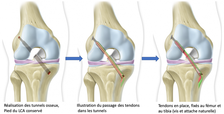 LCA : Techniques opératoires - Nantes Chirurgie Jeunesse et Sport